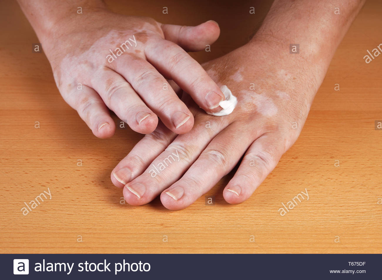 Vitiligo Skin Condition High Resolution Stock Photography and Images ...