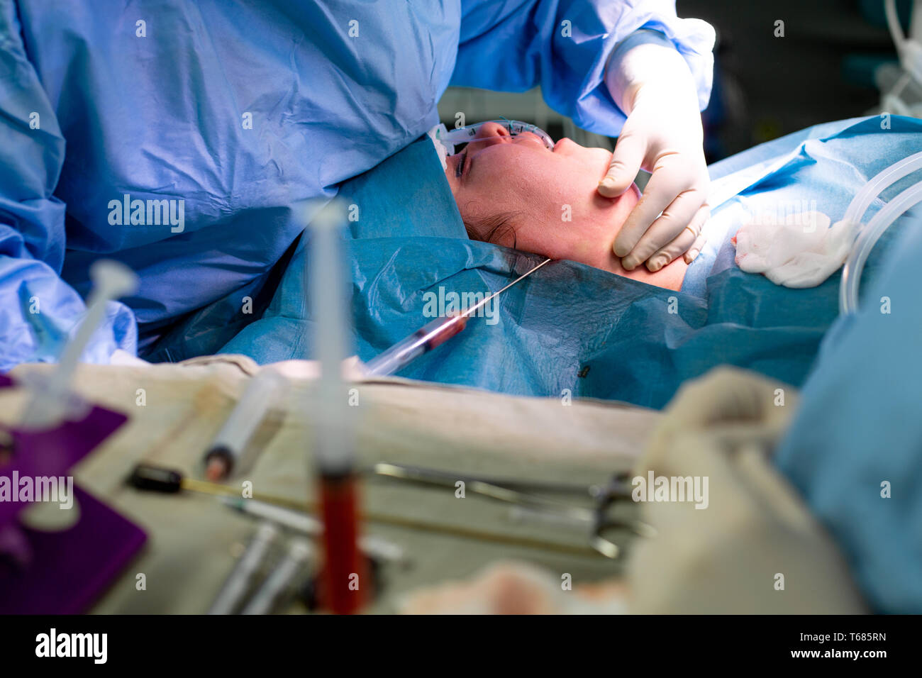 Hands Holding Syringe and Transfer Fat with Nano Fat Transfer Tool in ...