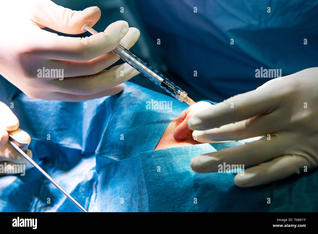 Surgeon and his assistant performing cosmetic surgery on nose in ...