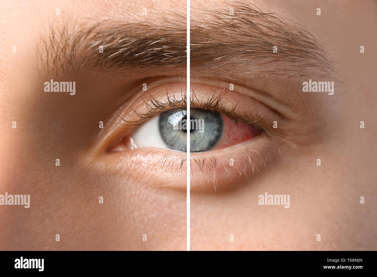 Man red eyes irritation hi-res stock photography and images - Alamy