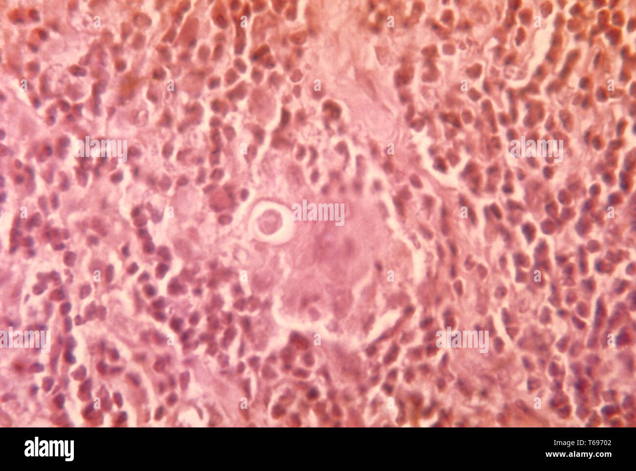 Photomicrograph of histopathologic changes in paracoccidioidomycosis ...