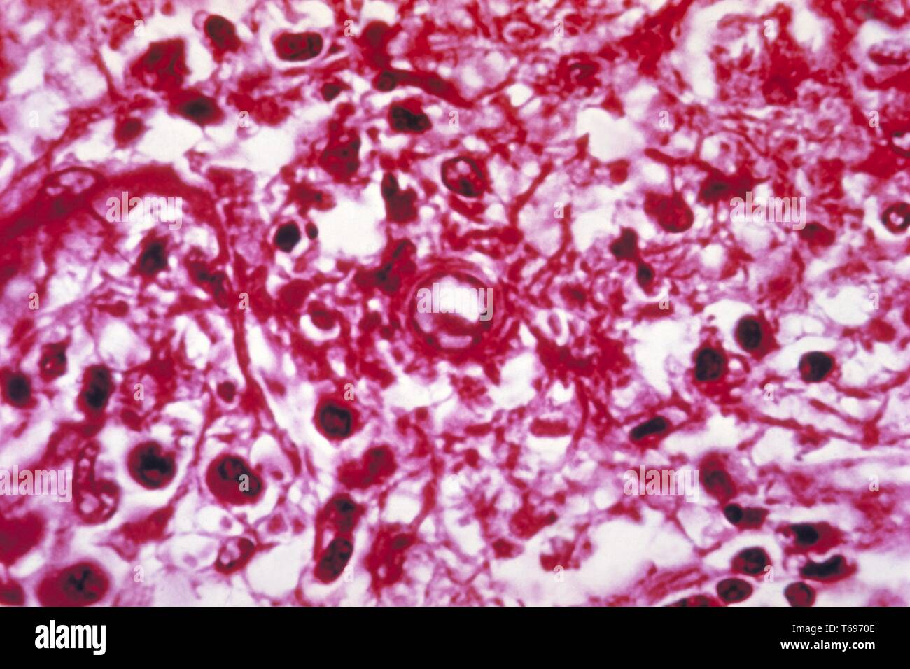 Photomicrograph of the histopathologic changes caused by the dimorphic ...
