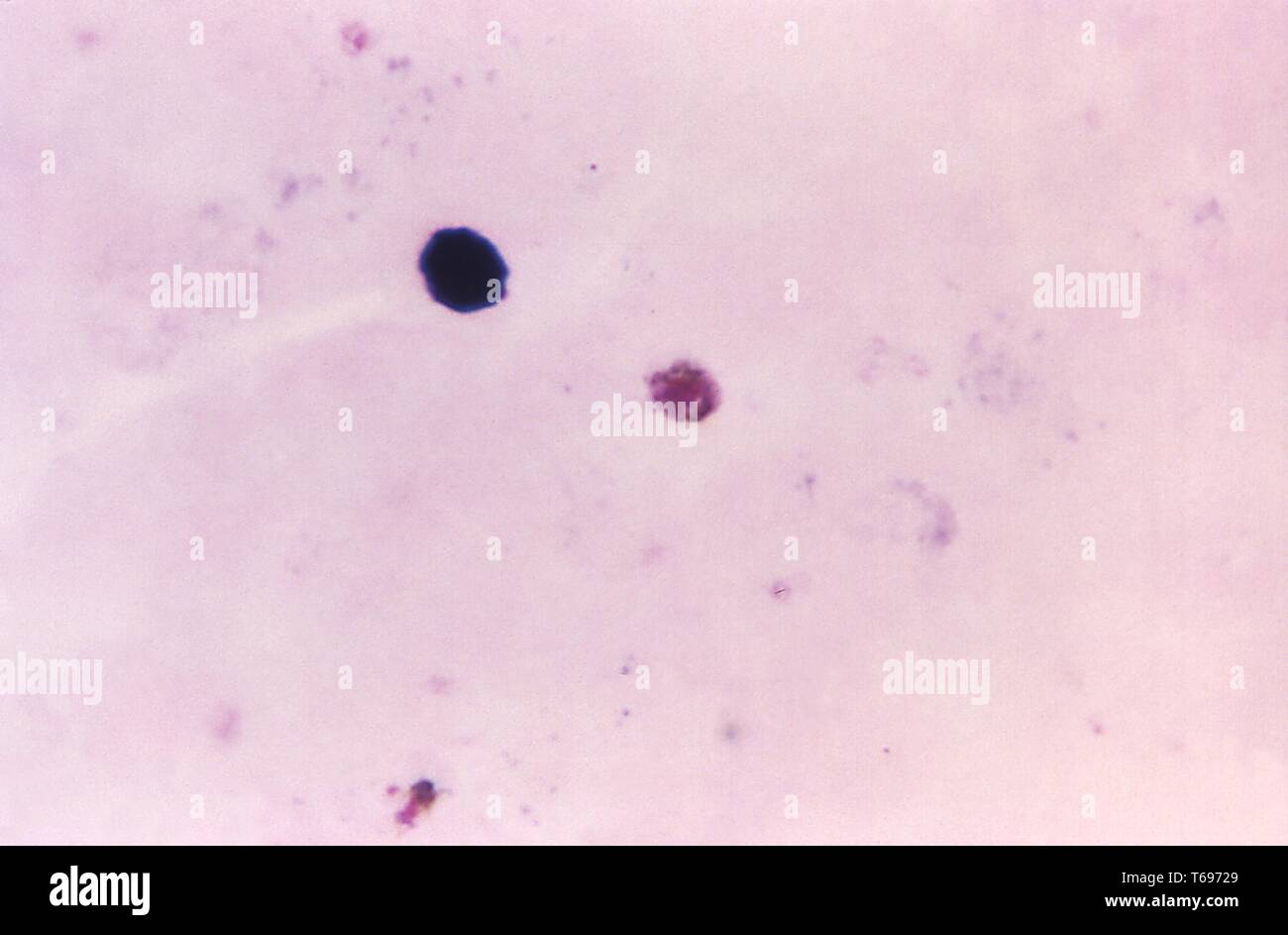 Giemsa stain thick film photomicrograph of a Plasmodium malariae ...