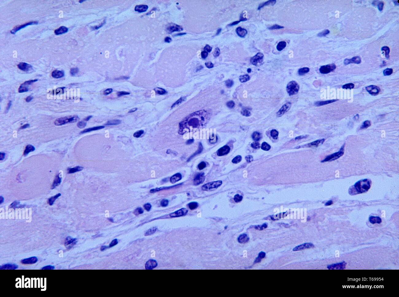 Intranuclear inclusion body hi-res stock photography and images - Alamy