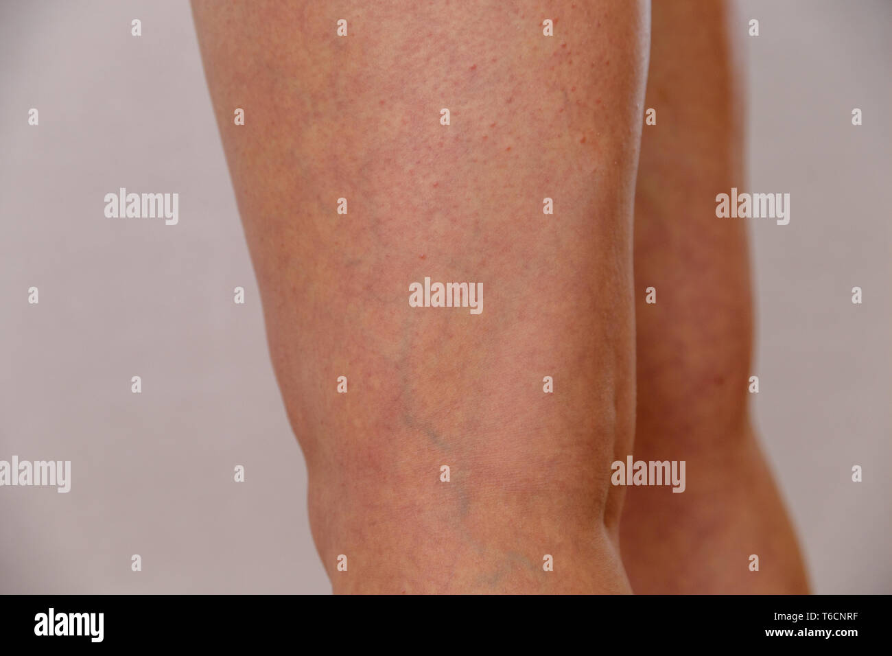 varicose veins of young woman Stock Photo - Alamy