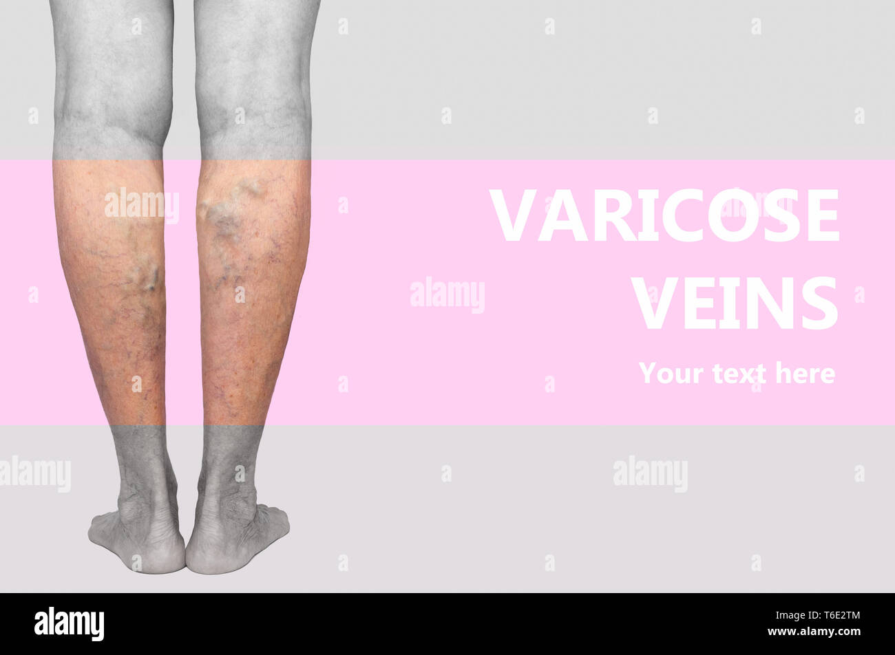 The female legs with veins varicose spider at studio Stock Photo - Alamy