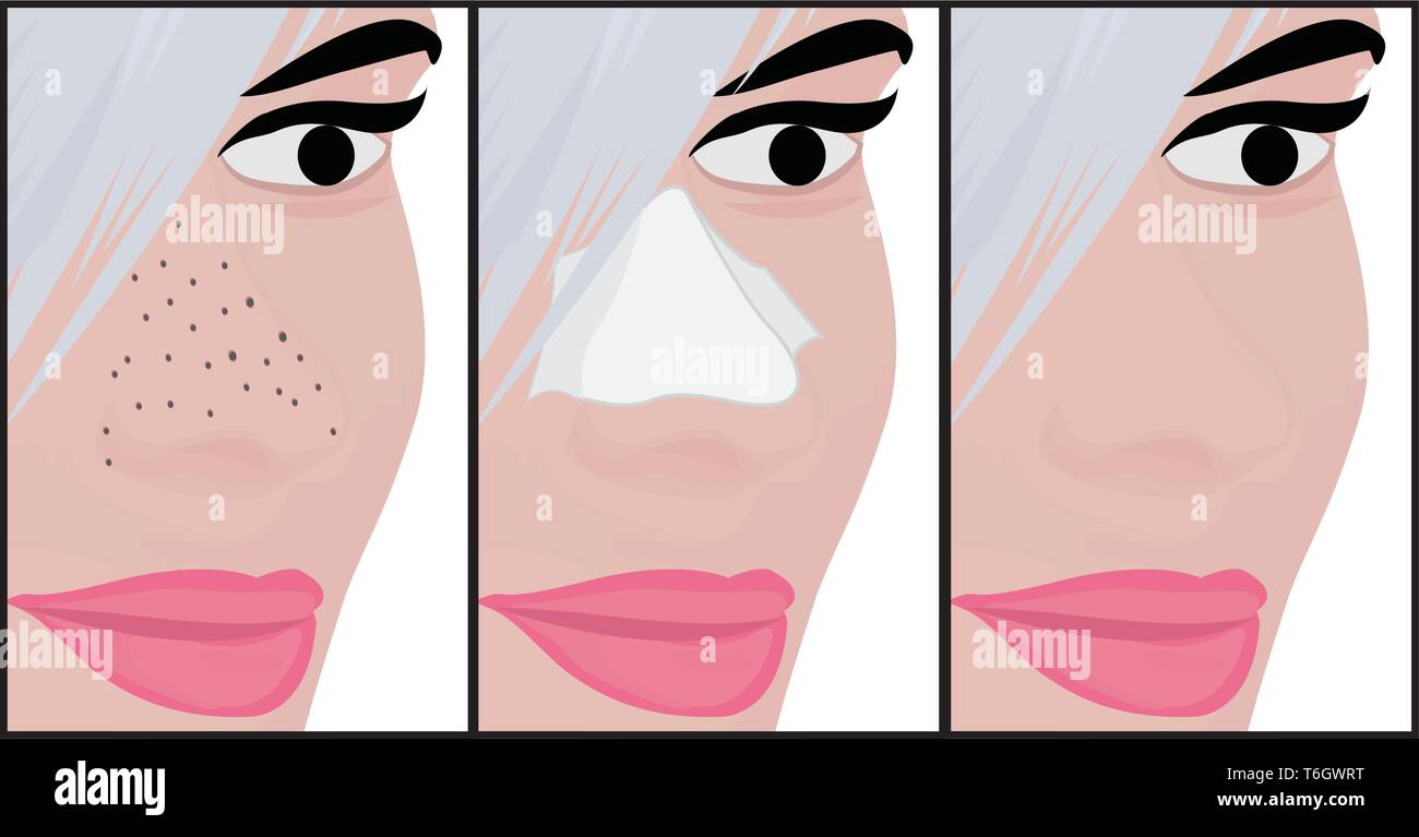 Acne black teen Stock Vector Images - Alamy