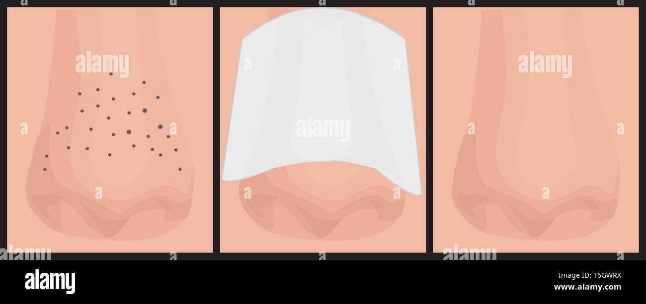 Blackheads on Nose treatment before and after. Pore reduce skin problems vector illustration ...