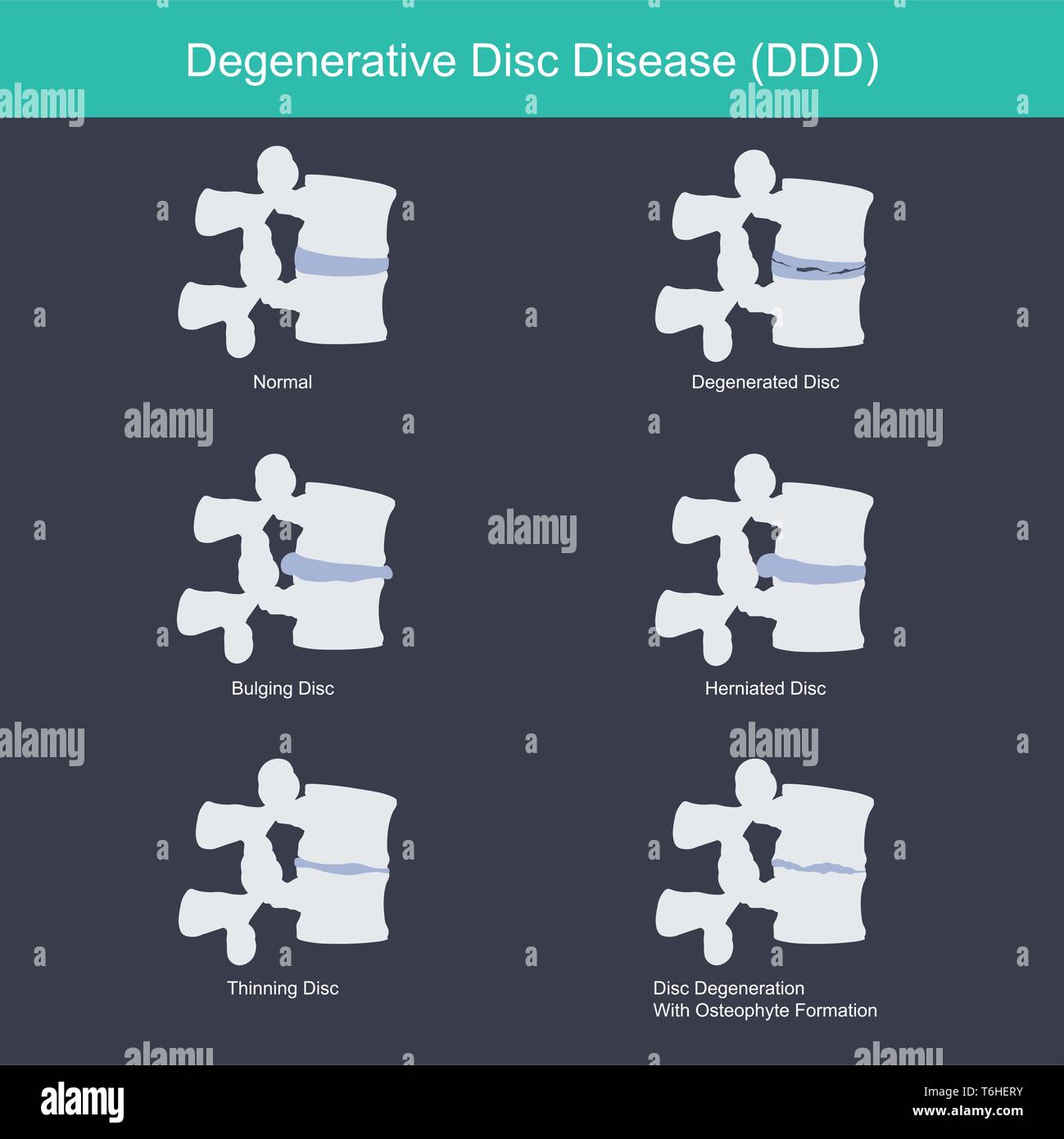 Bulging disc hi-res stock photography and images - Alamy