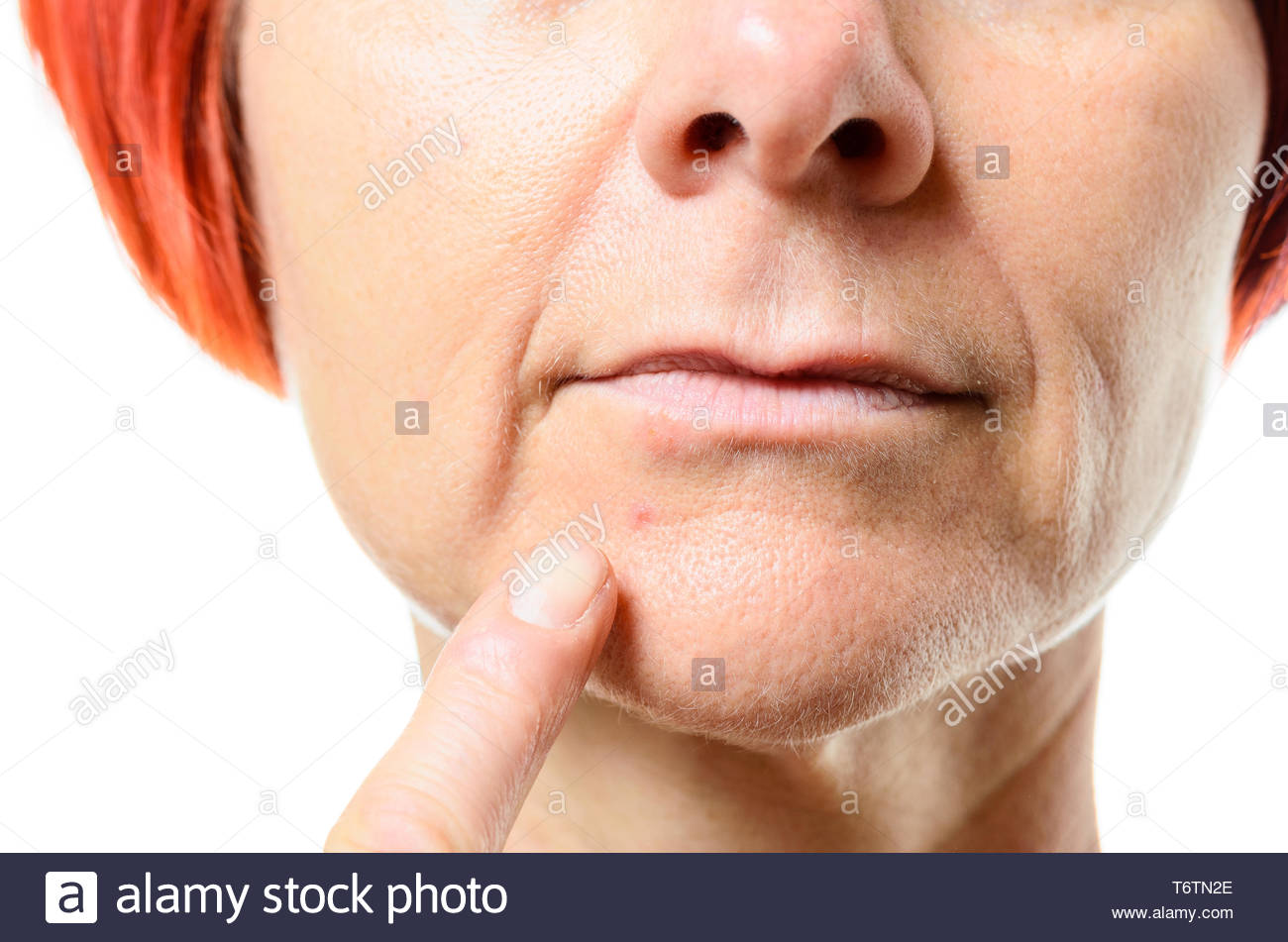 Blemish Face Stock Photos & Blemish Face Stock Images - Alamy