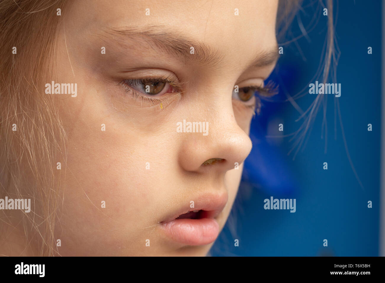 Ill child, conjunctivitis on the eyes Stock Photo - Alamy