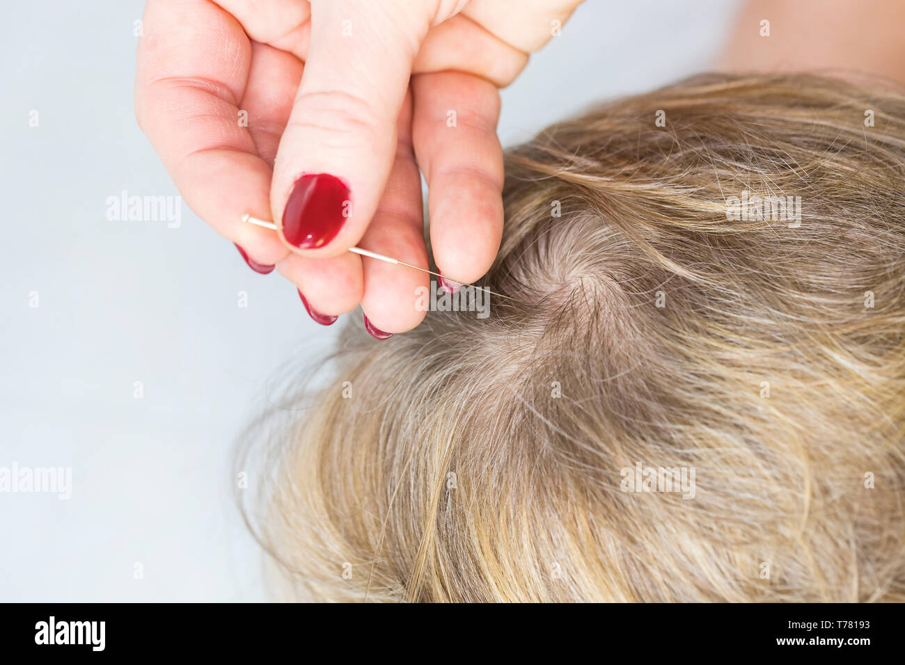 Elderly woman undergoing acupuncture procedure in a fat spa Stock Photo ...