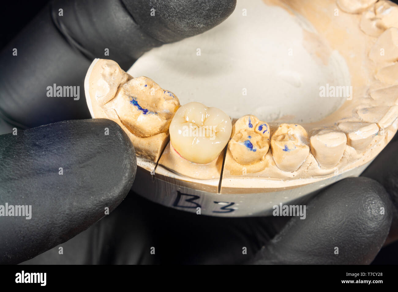 close-up ceramic tooth crown on a plaster model of teeth in the dentist ...