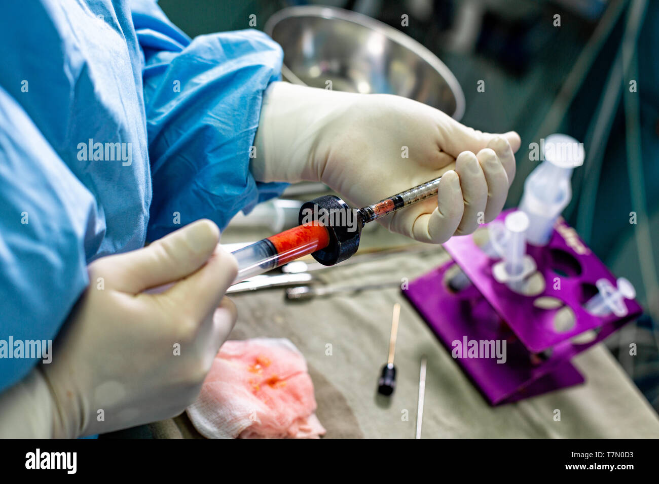 Hands Holding Syringe and Transfer Fat with Nano Fat Transfer Tool in ...