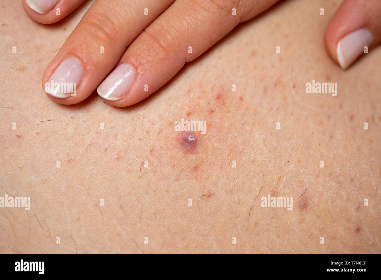 Close up picture of folliculitis on female skin - hands squeezing the ...