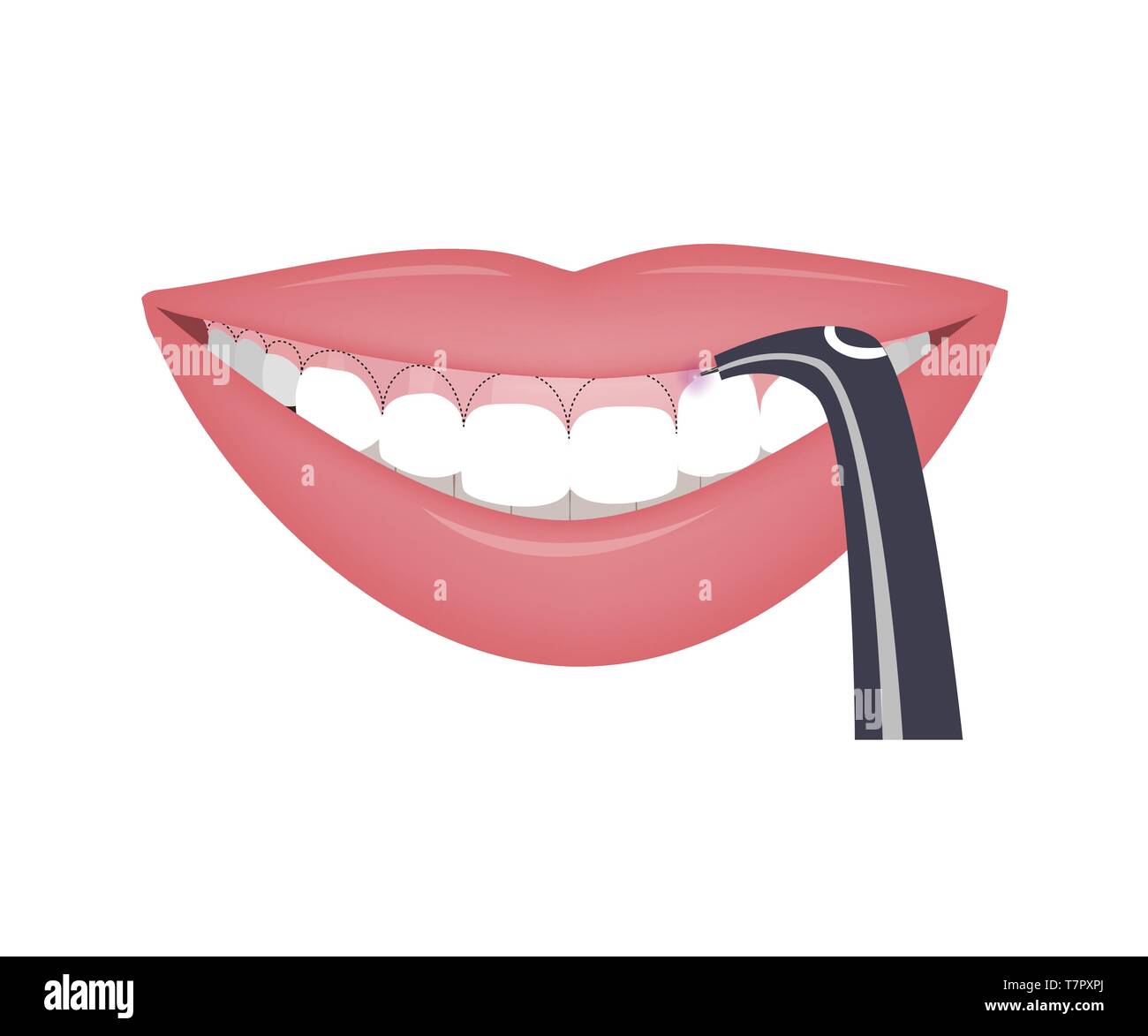 Laser correction of high smile line or gummy smile. Vector illustration ...