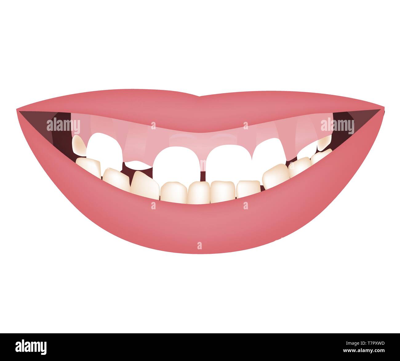 Kids mouth with a too big mandible and high smile line or gummy smile ...