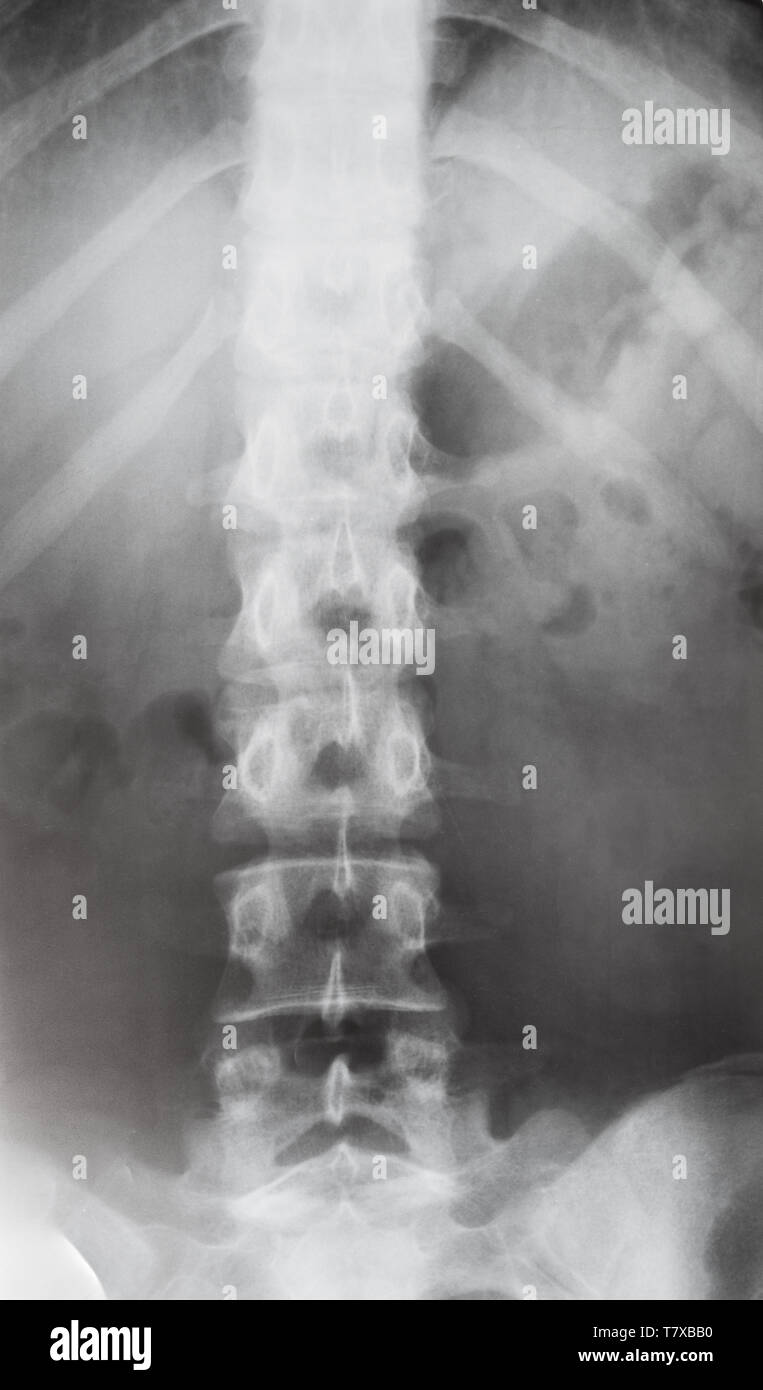 front view of human spine in torso on X-ray image Stock Photo - Alamy