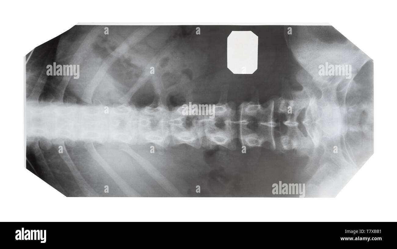 film with X-ray image of front view of human spine isolated on white ...