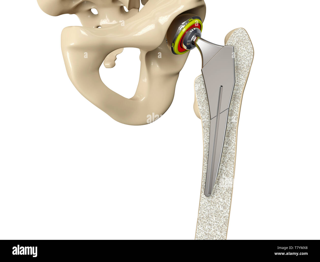 3D illustration of Hip replacement implant installed in the pelvis bone ...