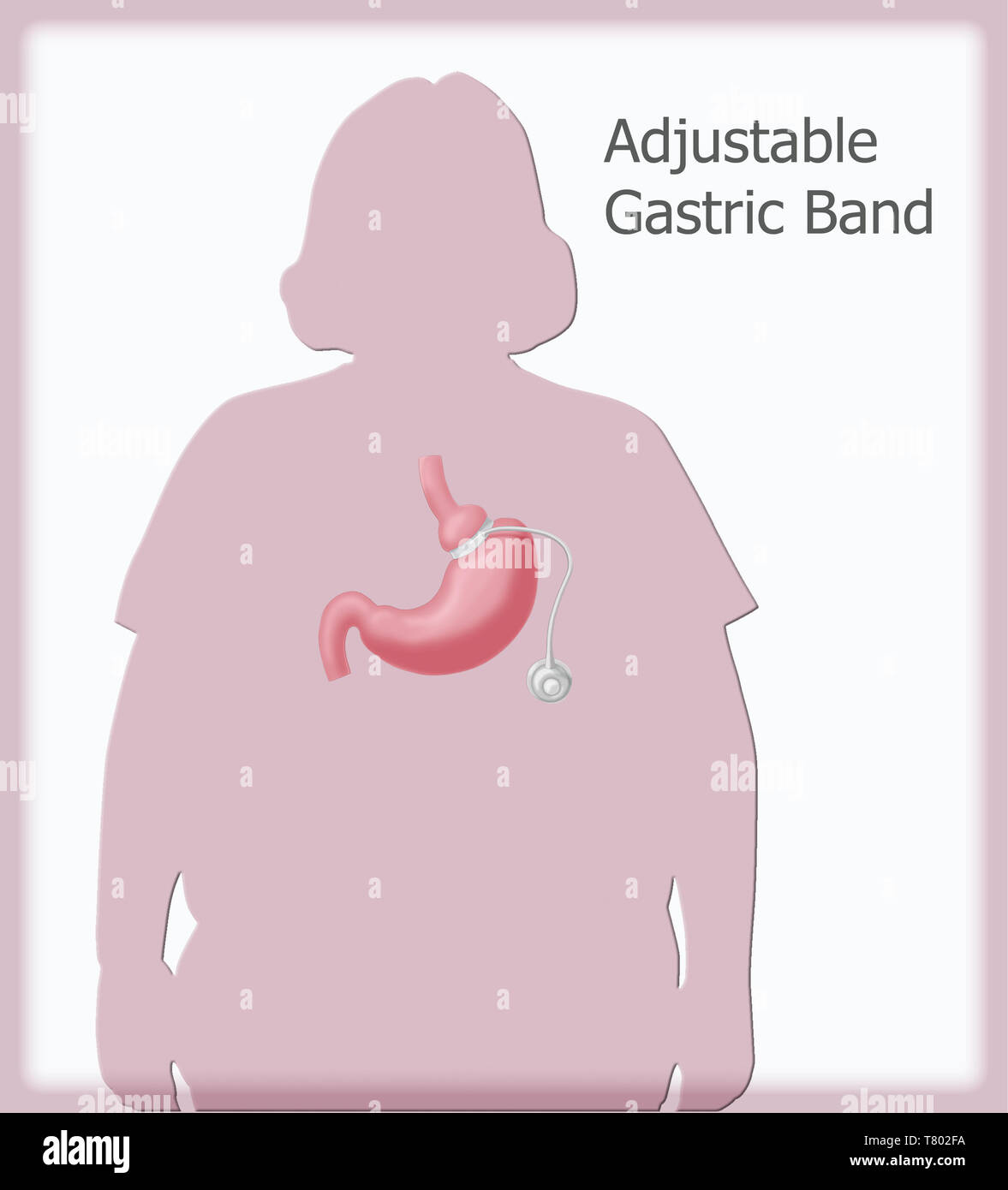 Laparoscopic gastric surgery hi-res stock photography and images - Alamy