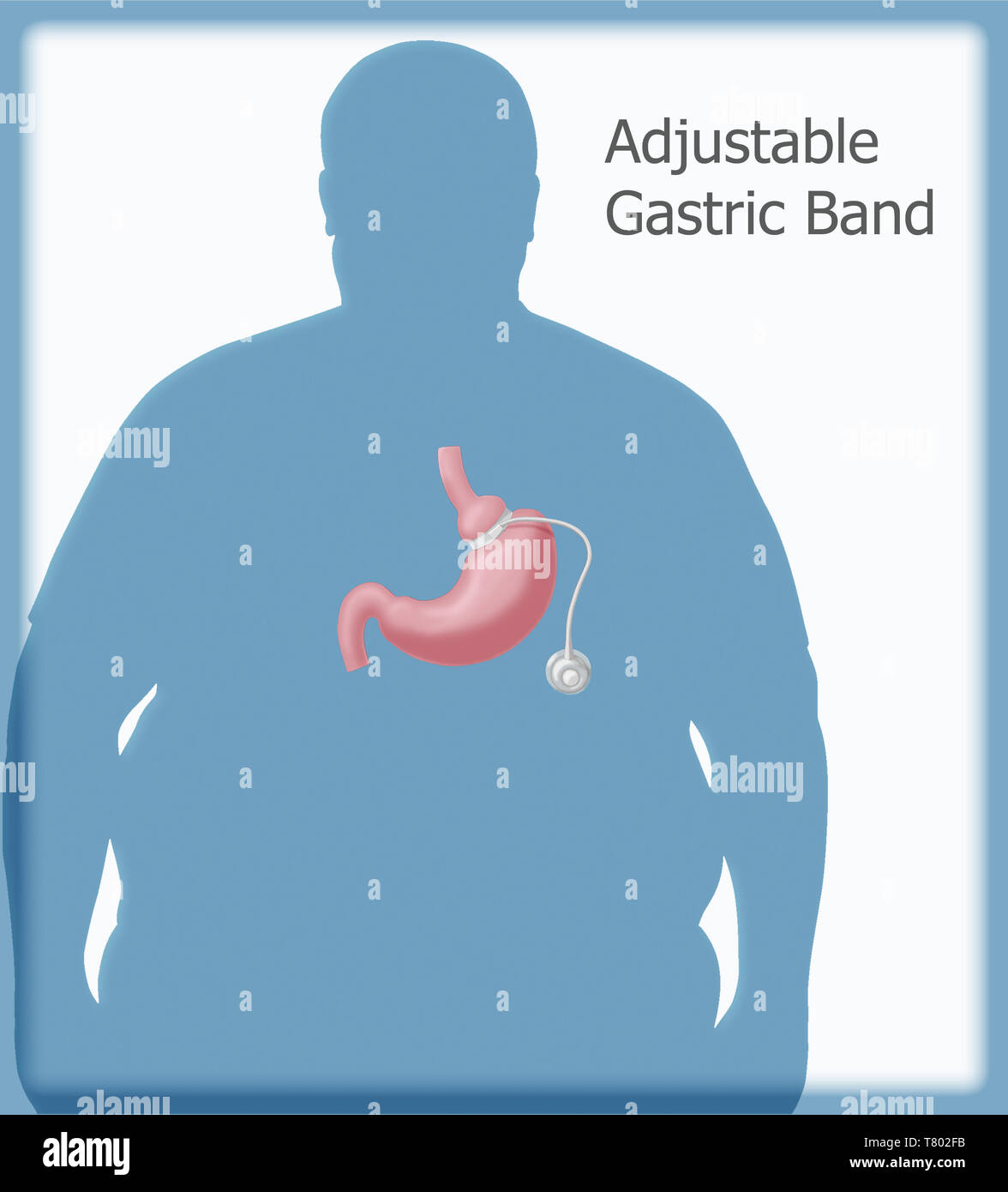 Obesity gastric band hi-res stock photography and images - Alamy
