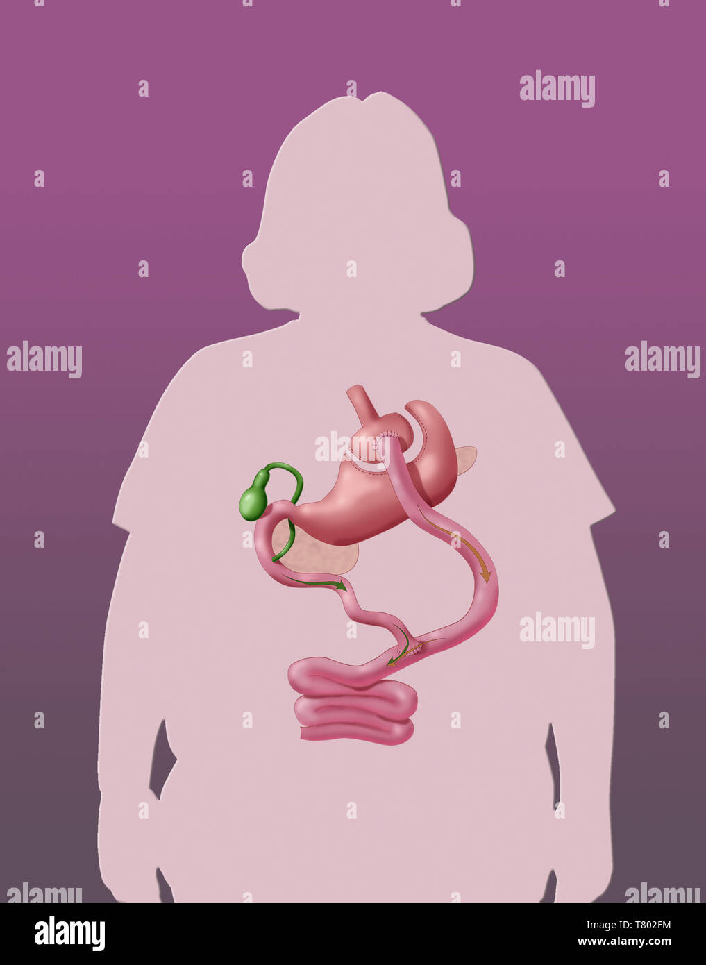 Roux-en-Y Gastric Bypass Surgery Stock Photo - Alamy