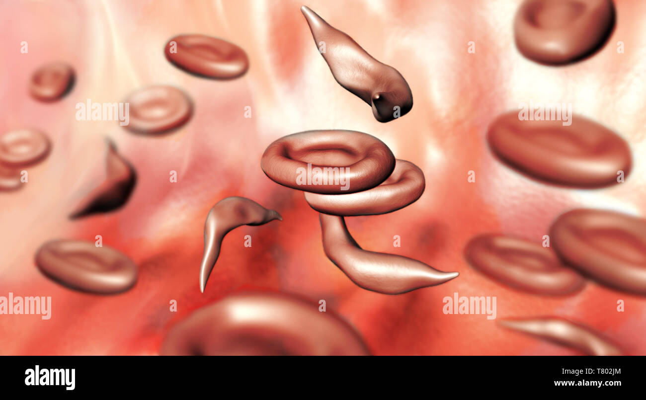 Sickle cell anemia blood cells hi-res stock photography and images - Alamy