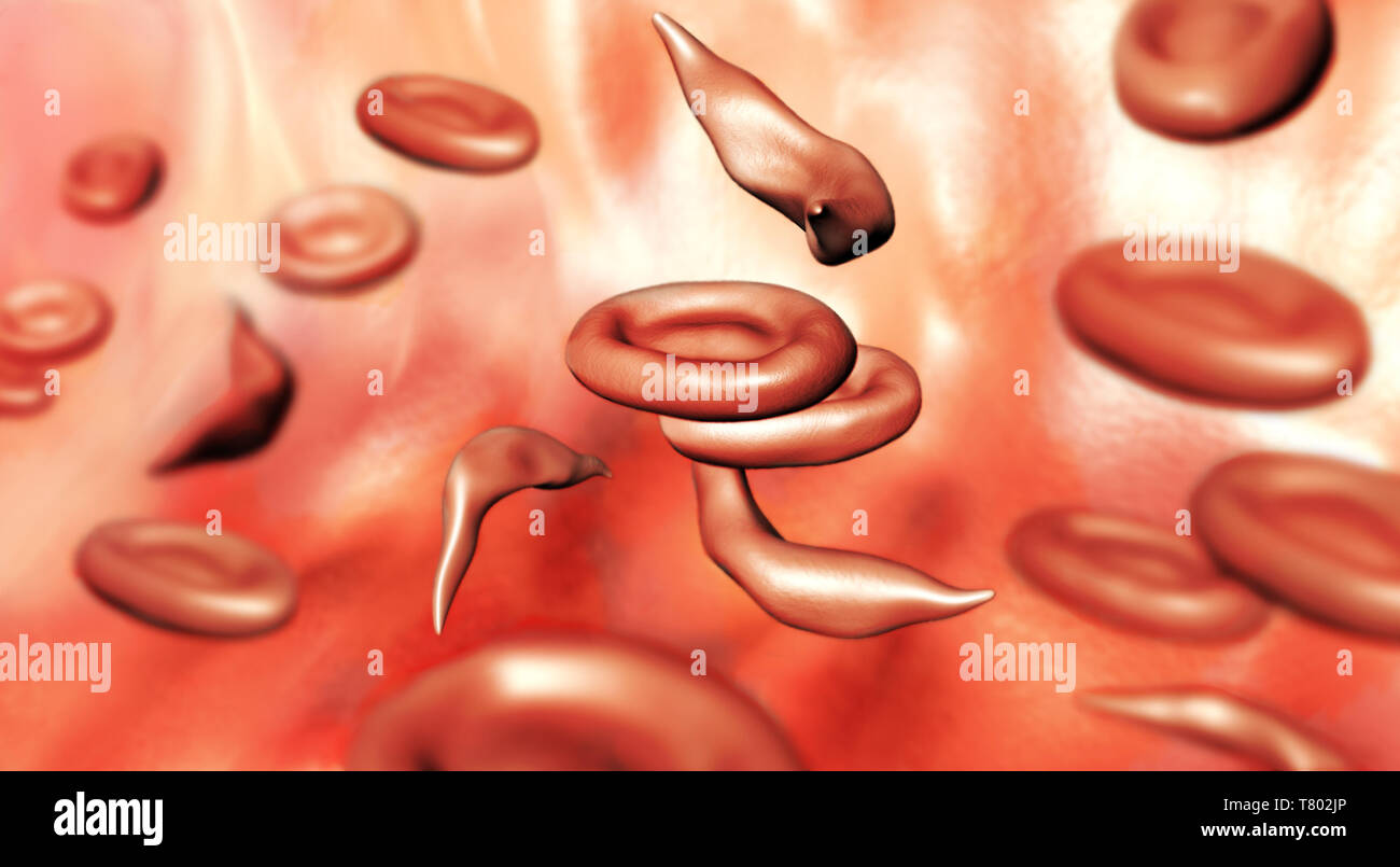 Sickle Cells, Illustration Stock Photo - Alamy