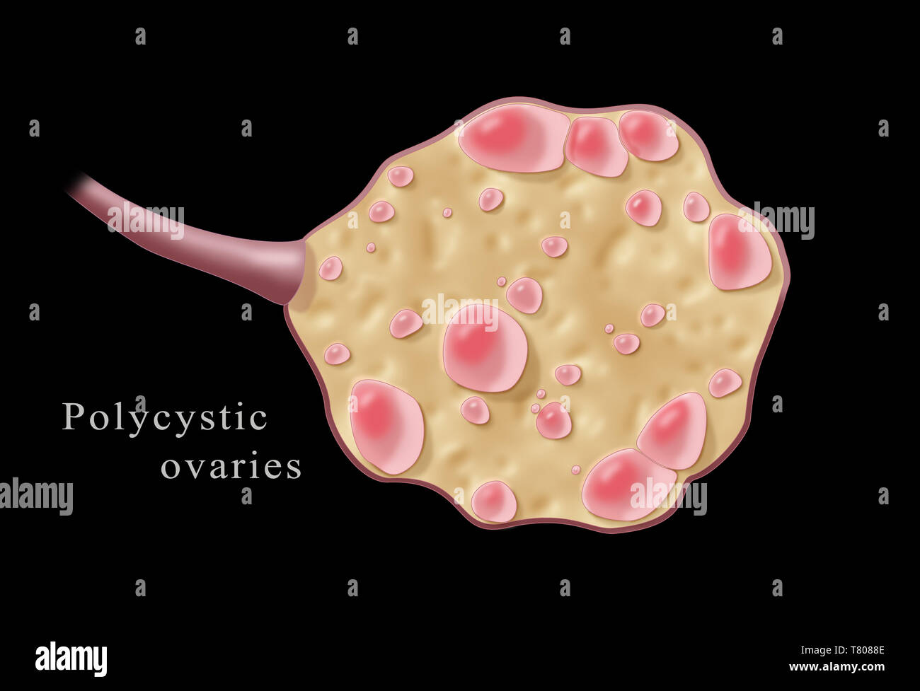 Polycystic ovaries hi-res stock photography and images - Alamy