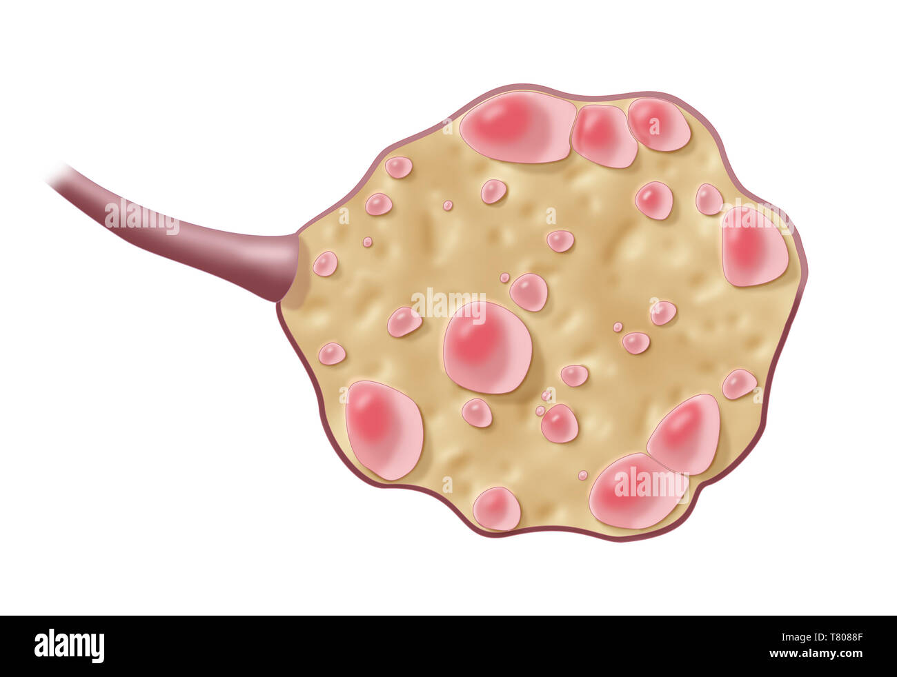 Polycystic ovary syndrome hi-res stock photography and images - Alamy