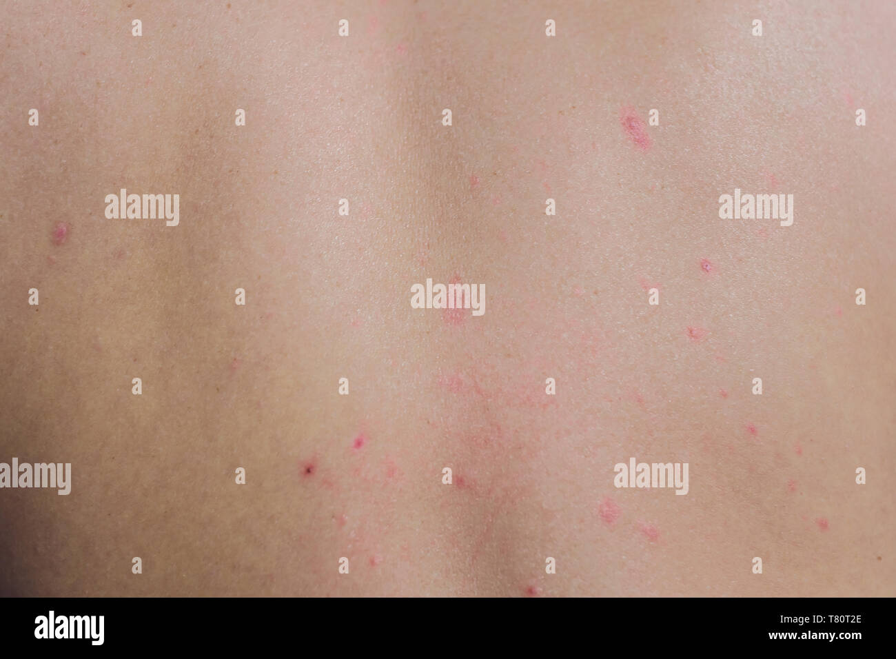 Health allergy skin care problem. Closeup young woman scratching her ...