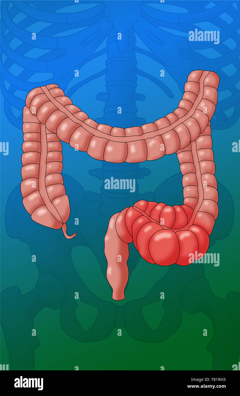 Abnormal colon hi-res stock photography and images - Alamy