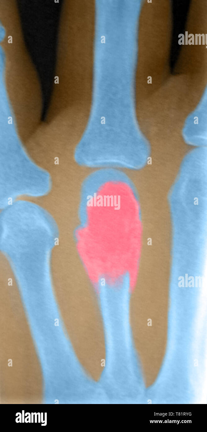 Giant Cell Bone Tumor in Hand, X-Ray Stock Photo - Alamy