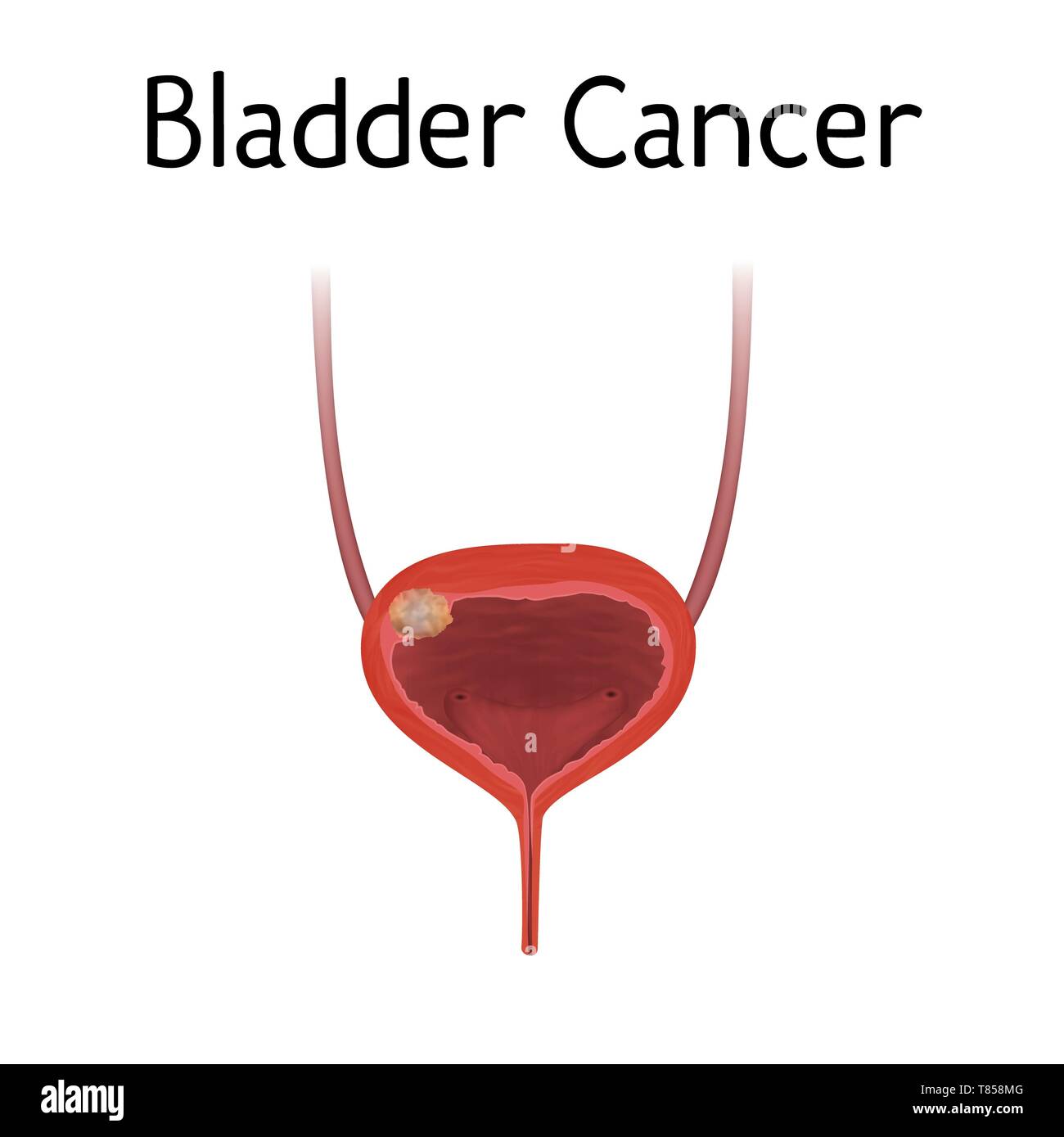 Bladder cancer female hi-res stock photography and images - Alamy