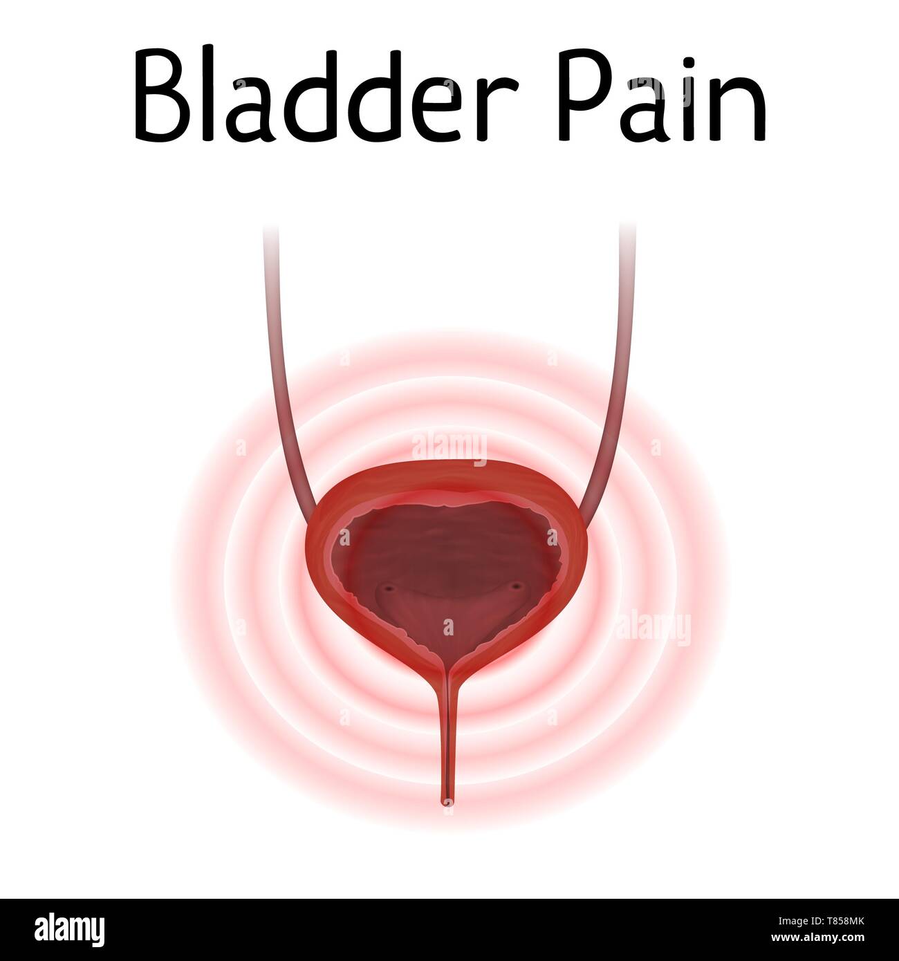 Abnormal urinary bladder hi-res stock photography and images - Alamy