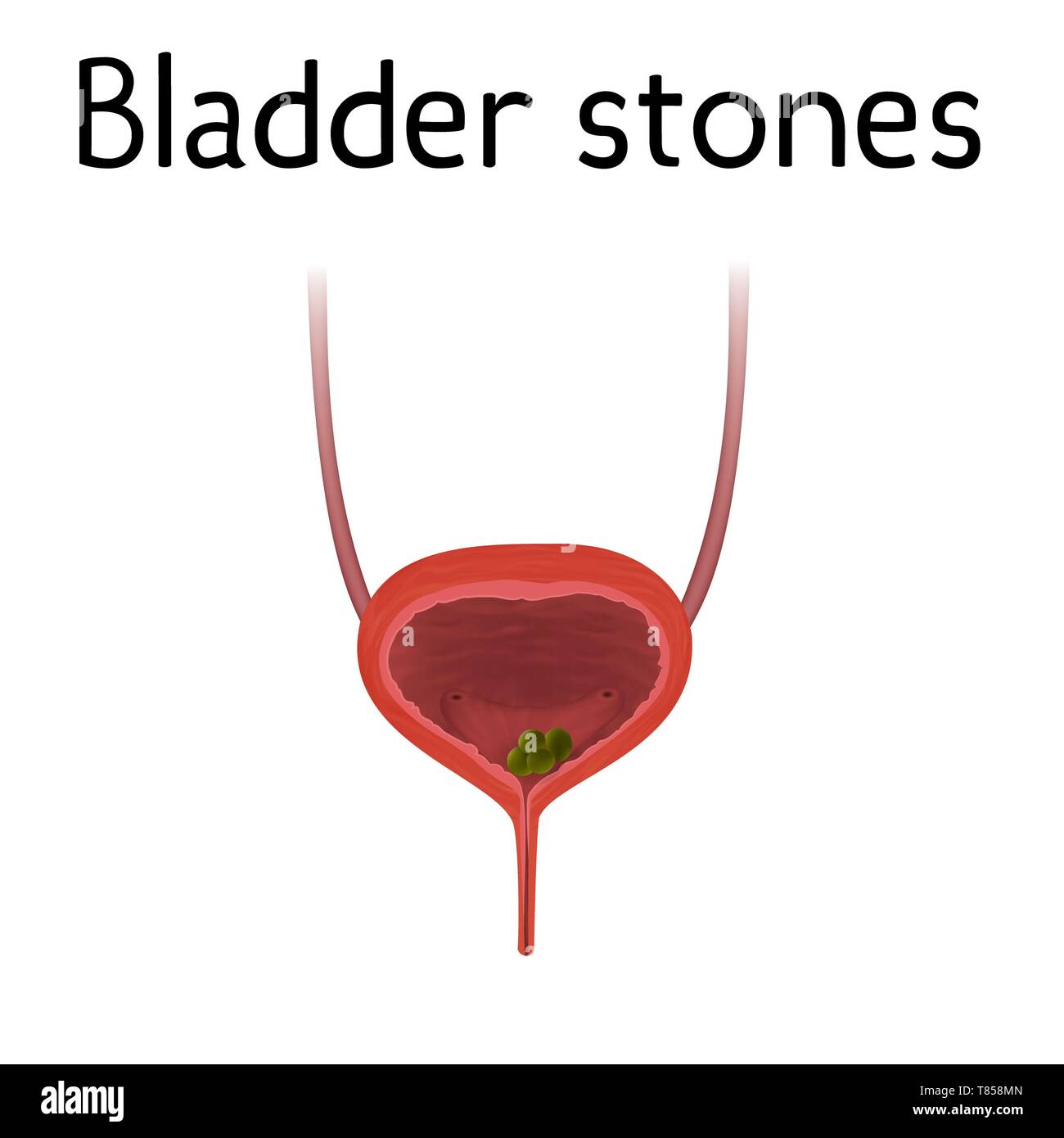 Bladder stones hi-res stock photography and images - Alamy