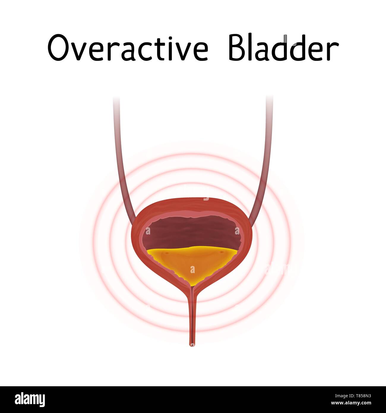 Overactive bladder, illustration Stock Photo - Alamy