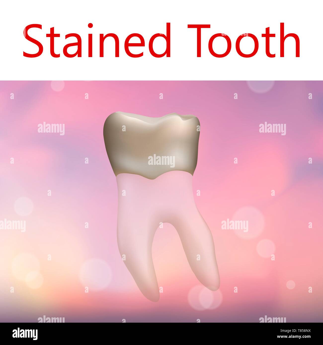Stained tooth, illustration Stock Photo - Alamy