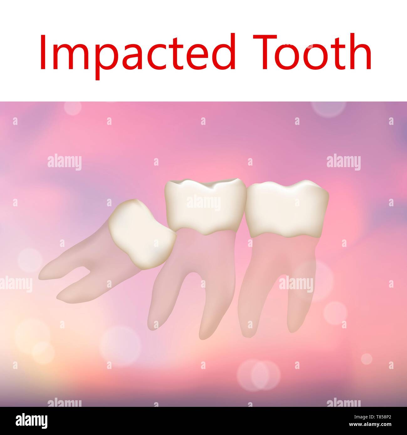 Impacted tooth, illustration Stock Photo - Alamy