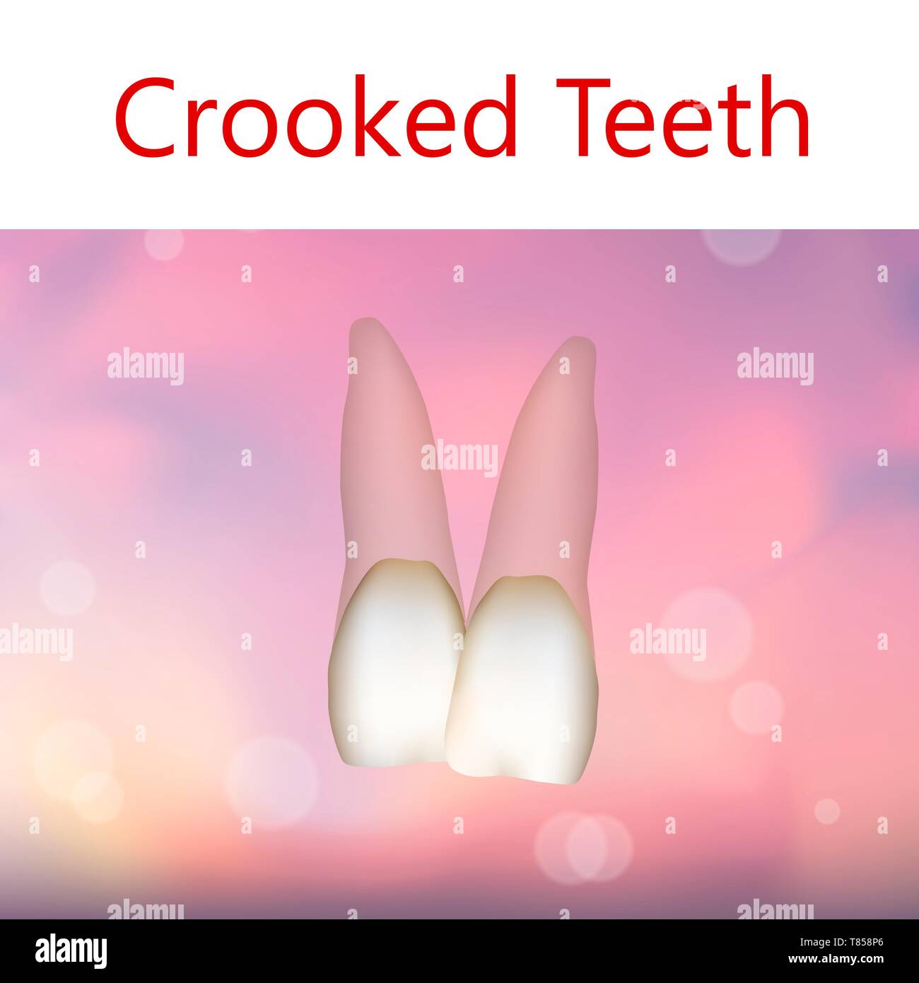 Crooked teeth, illustration Stock Photo - Alamy