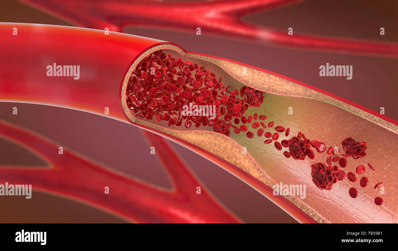 Arteriosclerosis hi-res stock photography and images - Alamy