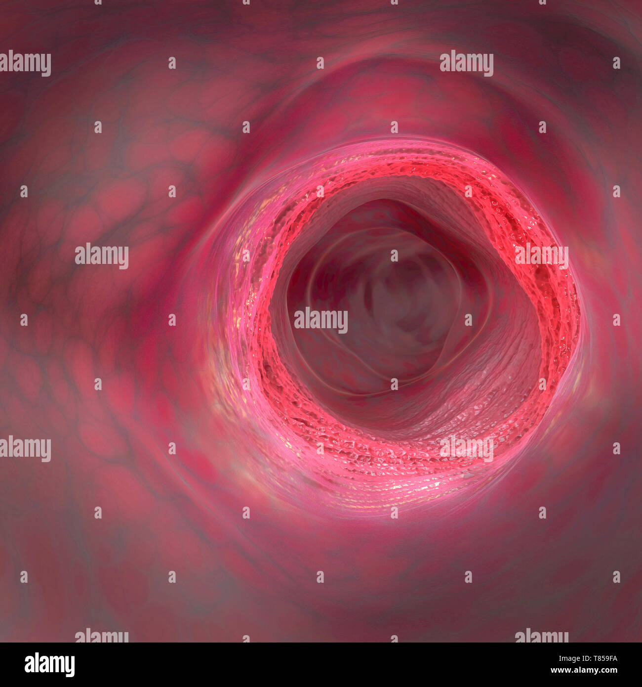 Inflammatory bowel disease, illustration Stock Photo - Alamy