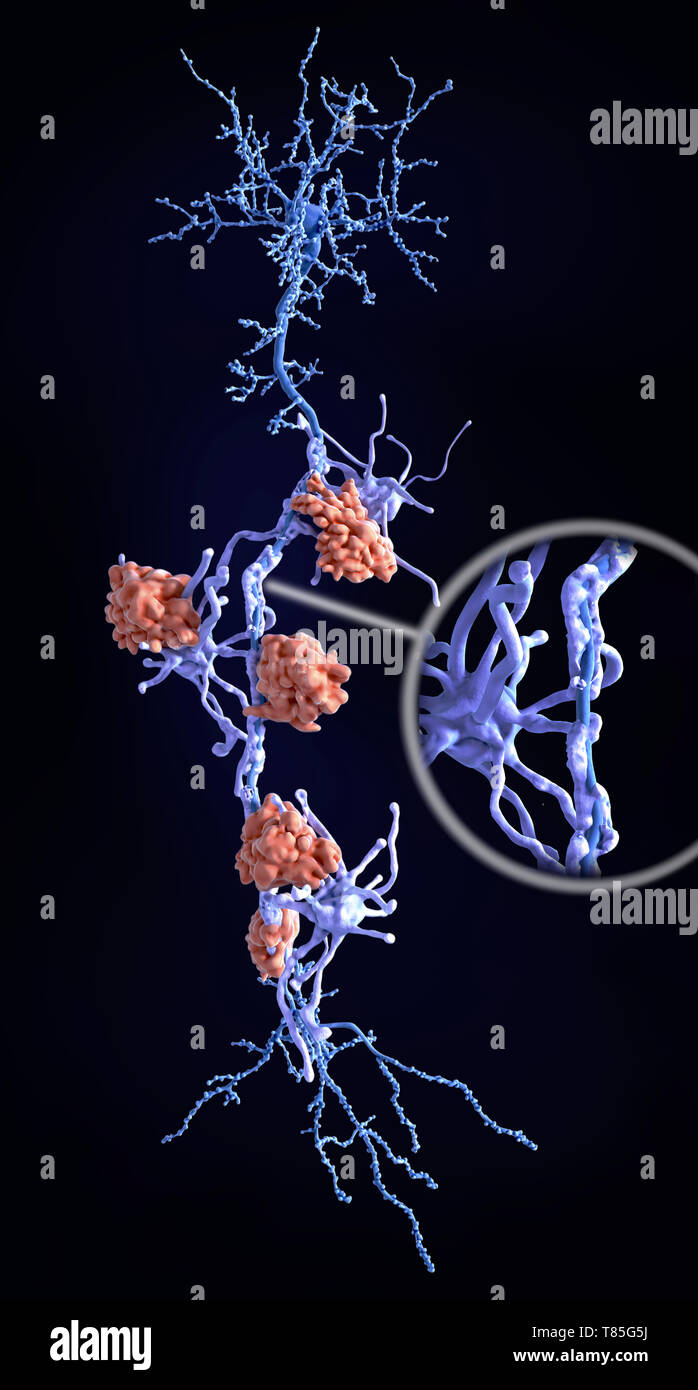 Nerve damage in multiple sclerosis, illustration Stock Photo - Alamy