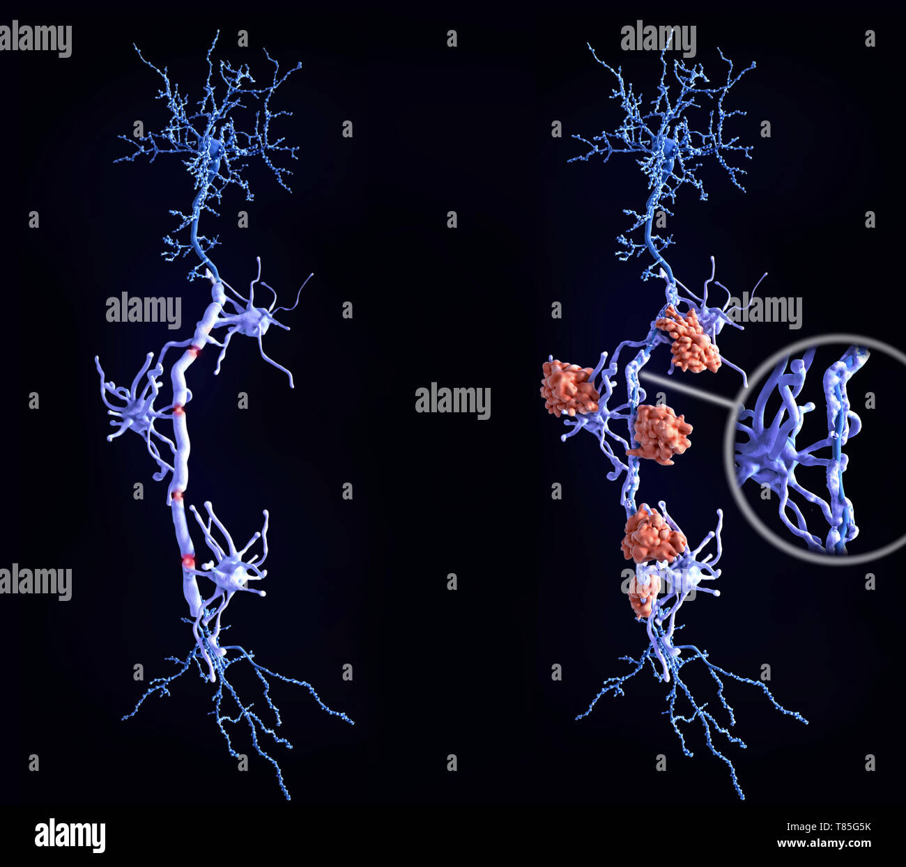 Healthy neurons and nerve damage in multiple sclerosis Stock Photo - Alamy