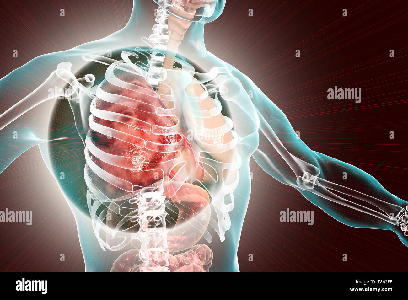 Grey hepatisation of lobar pneumonia, illustration Stock Photo - Alamy
