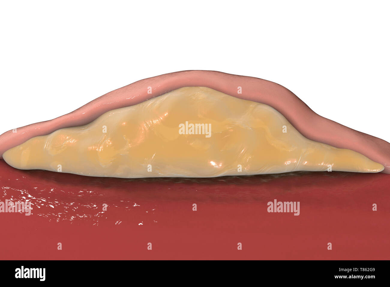 Lipoma hi-res stock photography and images - Alamy