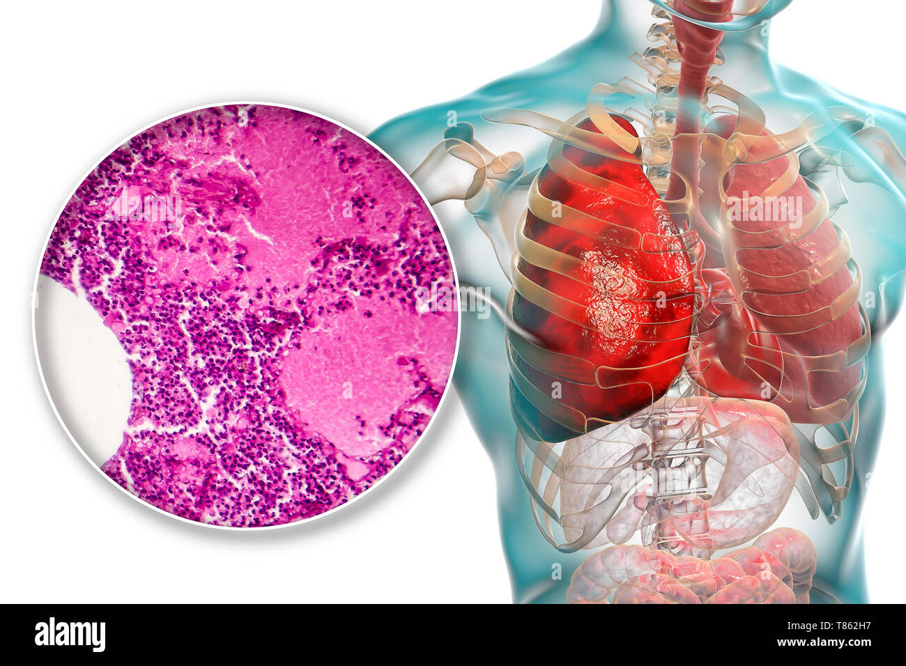 Lobar pneumonia, illustration and light micrograph Stock Photo - Alamy