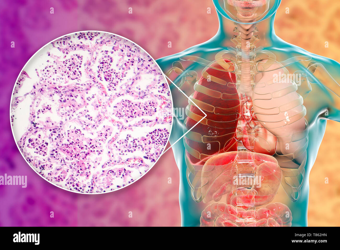 Lobar pneumonia, illustration and light micrograph Stock Photo - Alamy