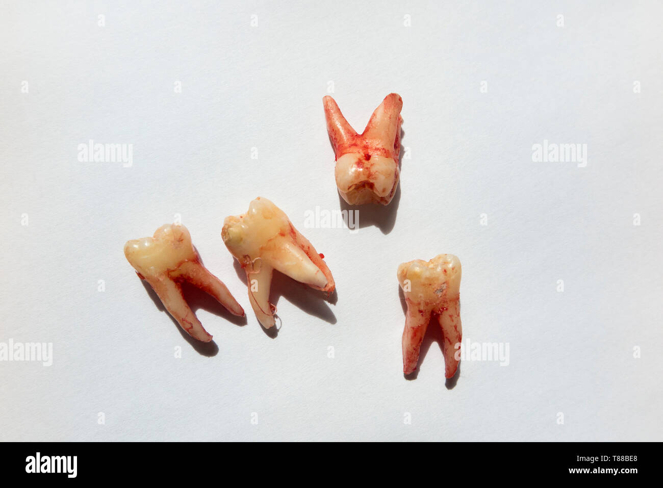 Upper molar hi-res stock photography and images - Alamy
